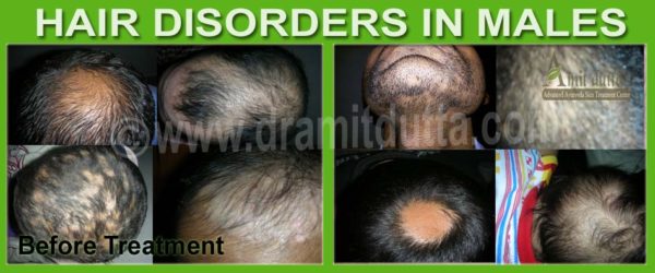 Causes of Hair Disorders - AYURVEDA HAIR TREATMENT