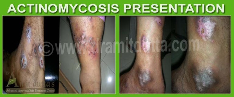 Actinomycosis Ayurvedic Medicine Treatment in India.