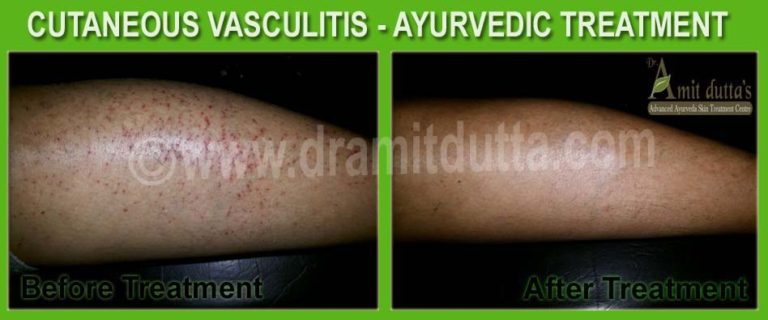 Cutaneous Vasculitis - Ayurvedic Medicine Treatment in India