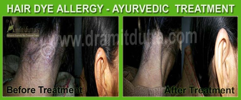 Hair Dye Allergy Treatment - Dr. Amit Dutta