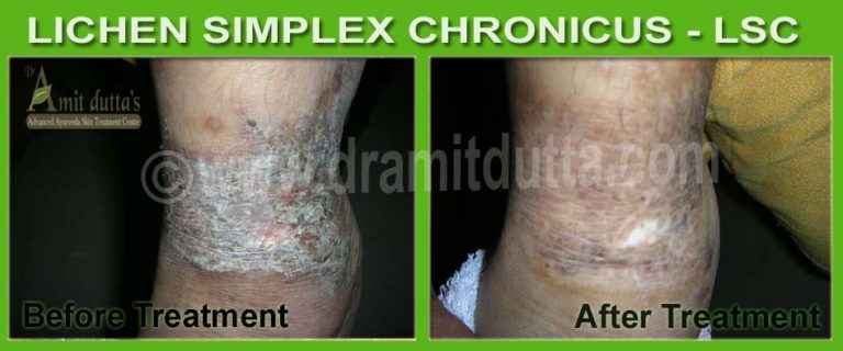 Lichen Simplex Chronicus - Dr. Amit Dutta