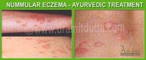 Nummular Eczema Ayurvedic treatment in India. Dr. Amit Dutta