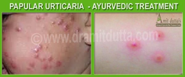 Ayurvedic Treatment for Urticaria | Ayurvedic medicines