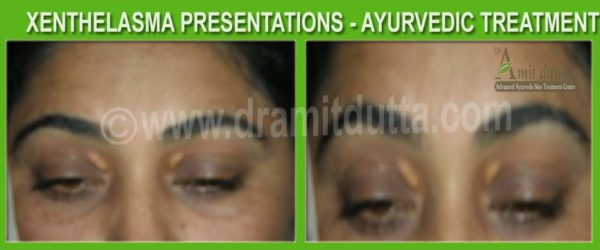 Xanthelasma treatment in Ayurveda. Skin Specialist in India
