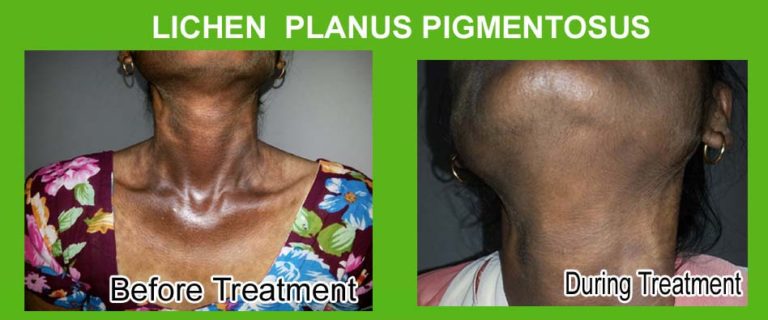 Lichen Planus Pigmentosus LPP Ayurvedic Treatment in India